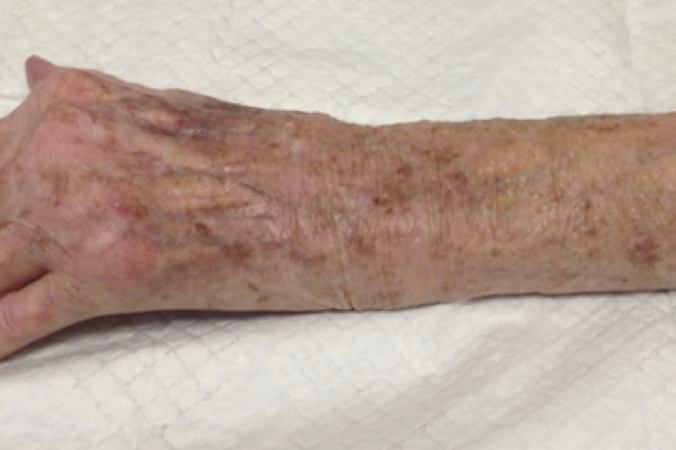 SOLAR LENTIGO | Hand Surgery Resource