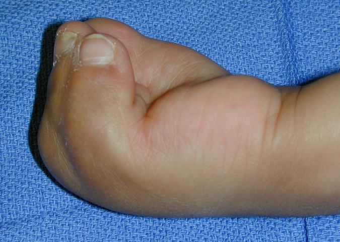 Apert's Syndrome - observation | Hand Surgery Resource