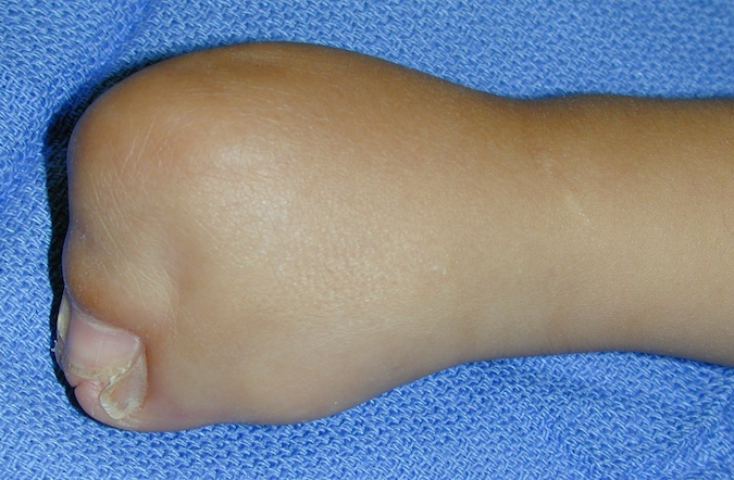 Apert's Syndrome - observation | Hand Surgery Resource