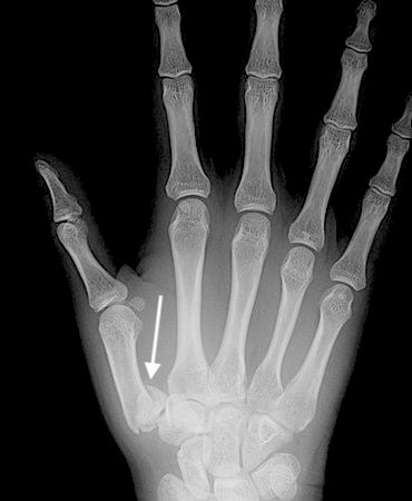 THUMB METACARPAL FRACTURES | Hand Surgery Resource