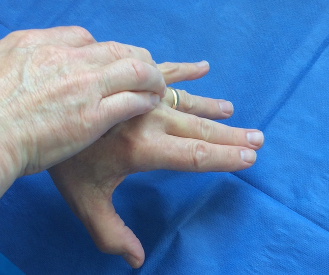 Bouvier's Maneuver | Hand Surgery Resource
