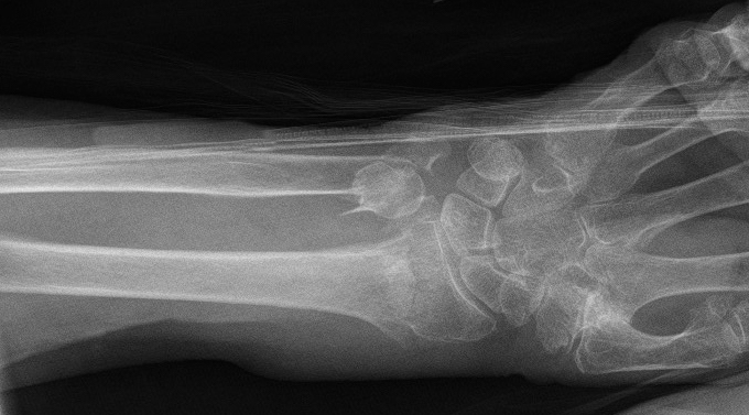DISTAL RADIUS FRACTURES | Hand Surgery Resource