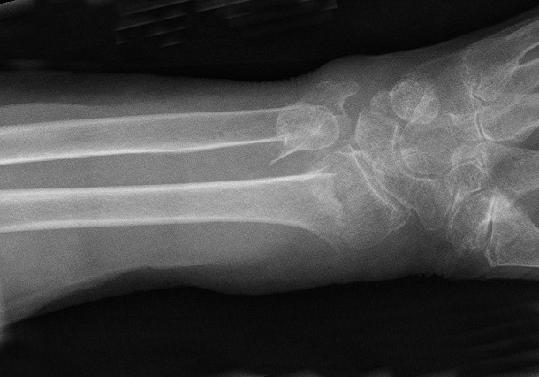 DISTAL RADIUS FRACTURES | Hand Surgery Resource