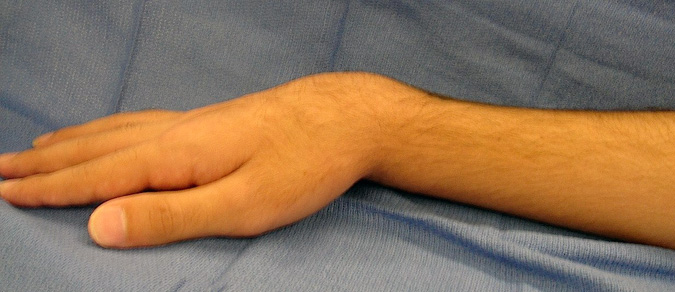 DISTAL RADIUS FRACTURES | Hand Surgery Resource