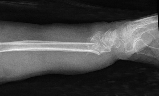 DISTAL RADIUS FRACTURES | Hand Surgery Resource