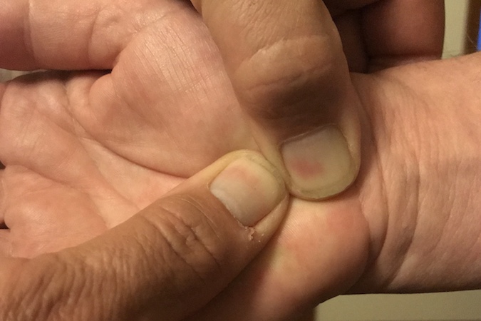 Median Nerve Compression (Durkan's Test) | Hand Surgery Resource