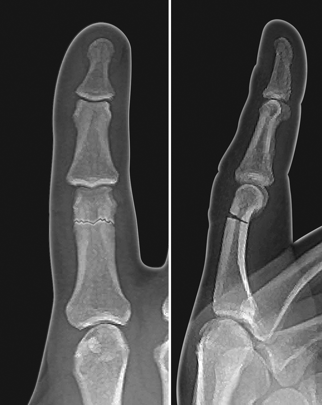 FINGER PROXIMAL PHALANX FRACTURE ADULT | Hand Surgery Resource