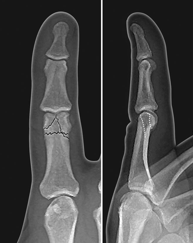 FINGER PROXIMAL PHALANX FRACTURE ADULT | Hand Surgery Resource