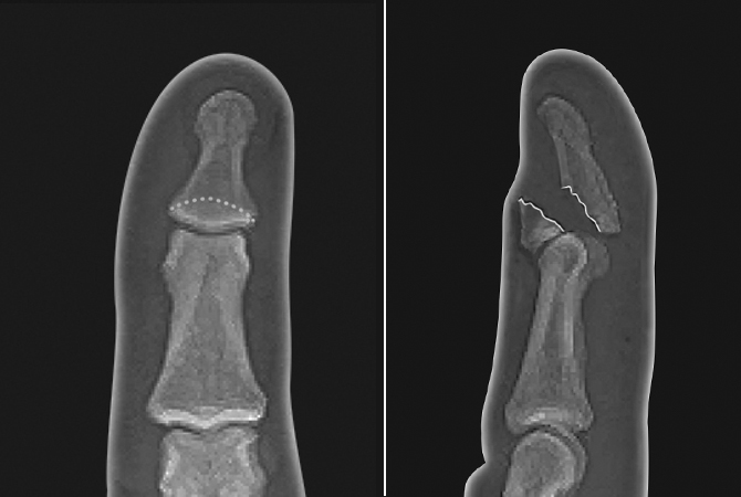 FRACTURAS DE FALANGE DISTAL DEL DEDO | Recurso de cirugía de mano