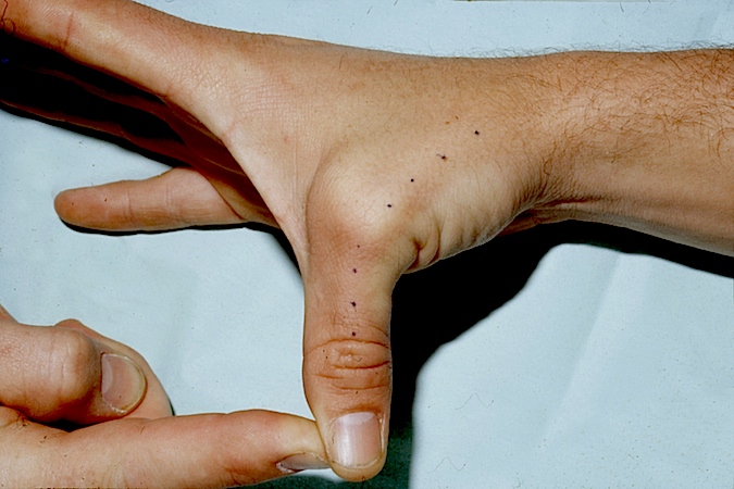 THUMB SPRAIN (GAMEKEEPER'S) | Hand Surgery Resource