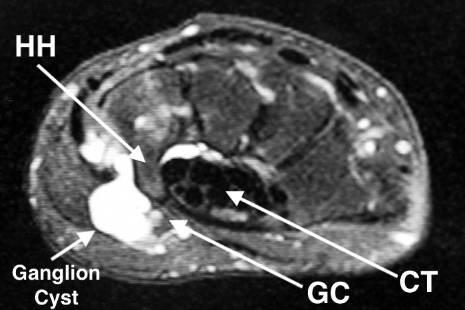 ULNAR ENTRAPMENT GUYON'S | Hand Surgery Resource