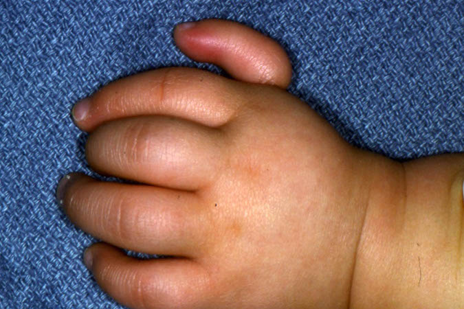 HYPOPLASTIC THUMB & POUCE FLOTTANT | Hand Surgery Resource