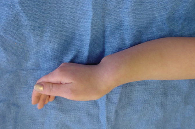 Madelung's Deformity - observation | Hand Surgery Resource