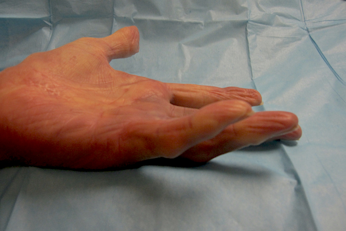 RAYNAUD'S DISEASE | Hand Surgery Resource