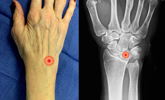 Tenderness | Hand Surgery Resource
