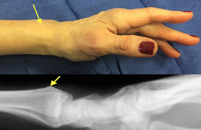 Tenderness | Hand Surgery Resource