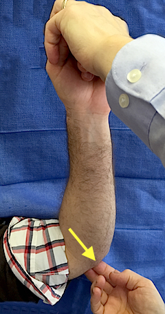 Tinel's Sign: Ulnar Nerve (Elbow) | Hand Surgery Resource