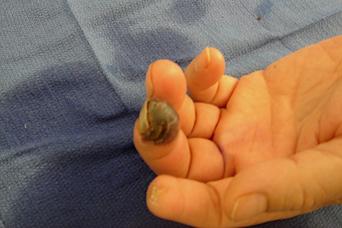 RAYNAUD'S PHENOMENON | Hand Surgery Resource